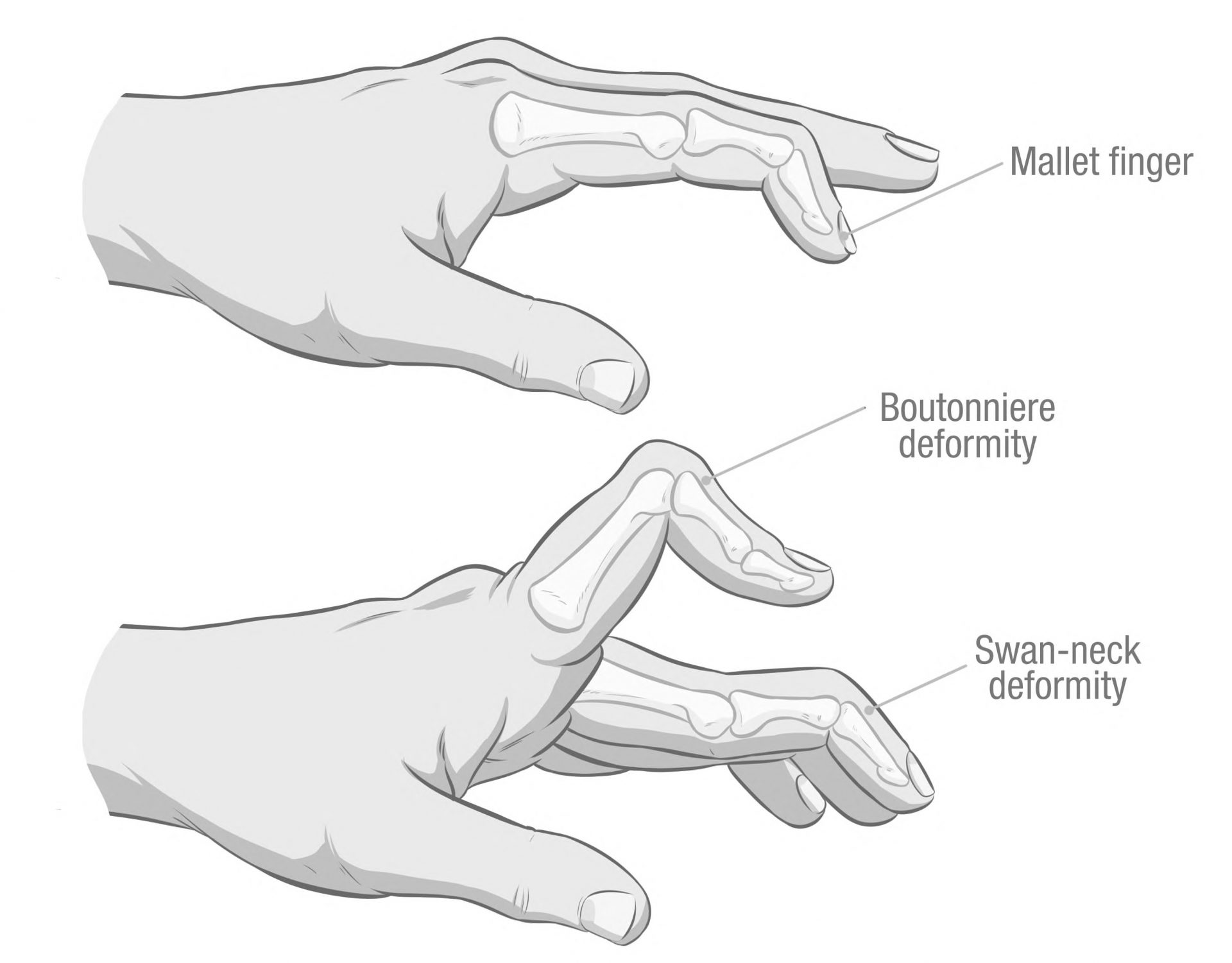 COMMON HAND AND WRIST INJURIES IN STRIKING SPORTS - PART 9 - Finger ...